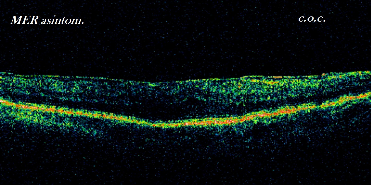 DEGENERACION MACULAR : MEMBRANAS en retina