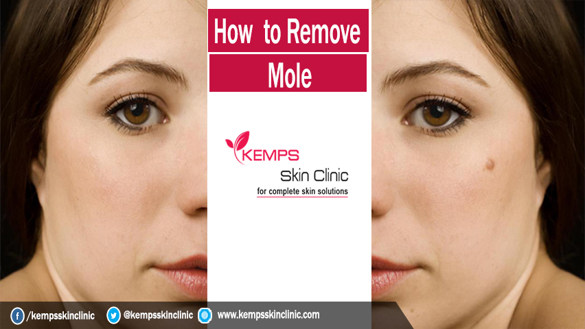 How can moles be treated? | KEMPS Skin Clinic