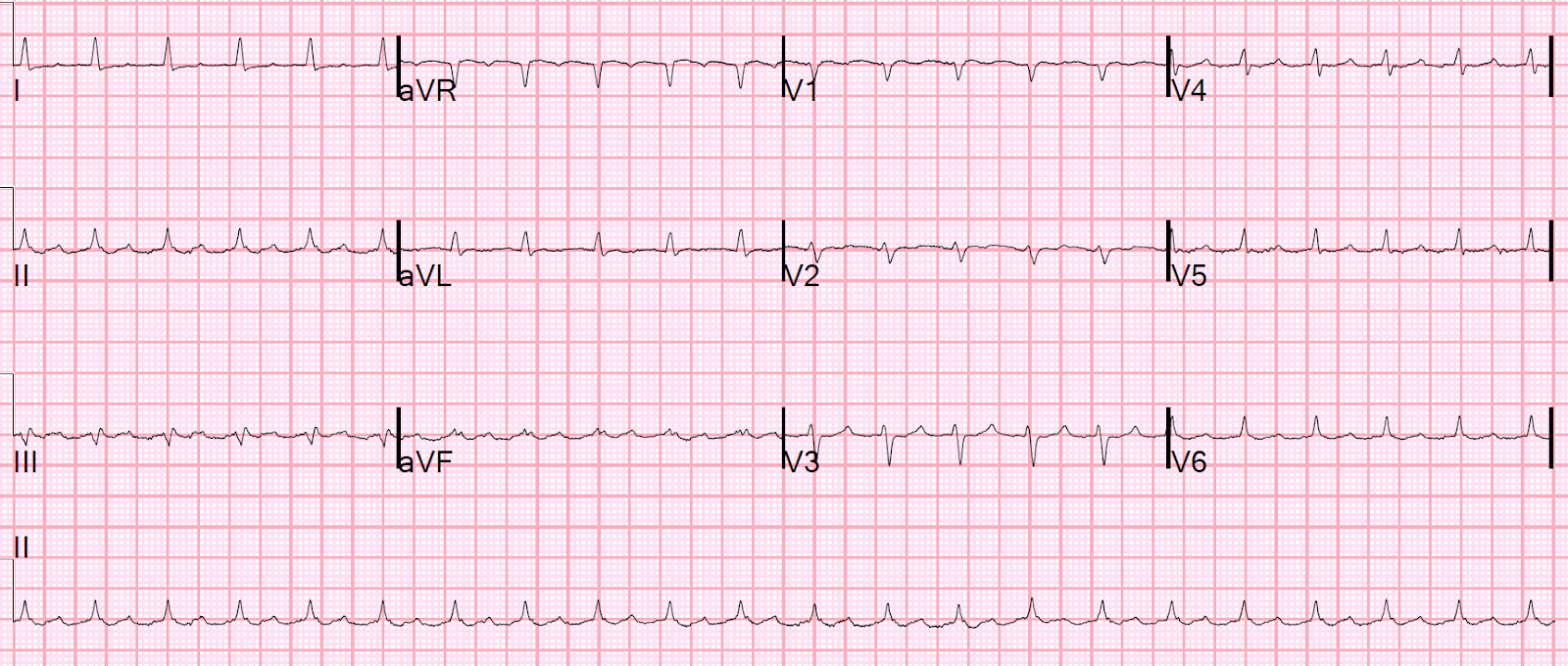 Ecg Pericardial Effusion