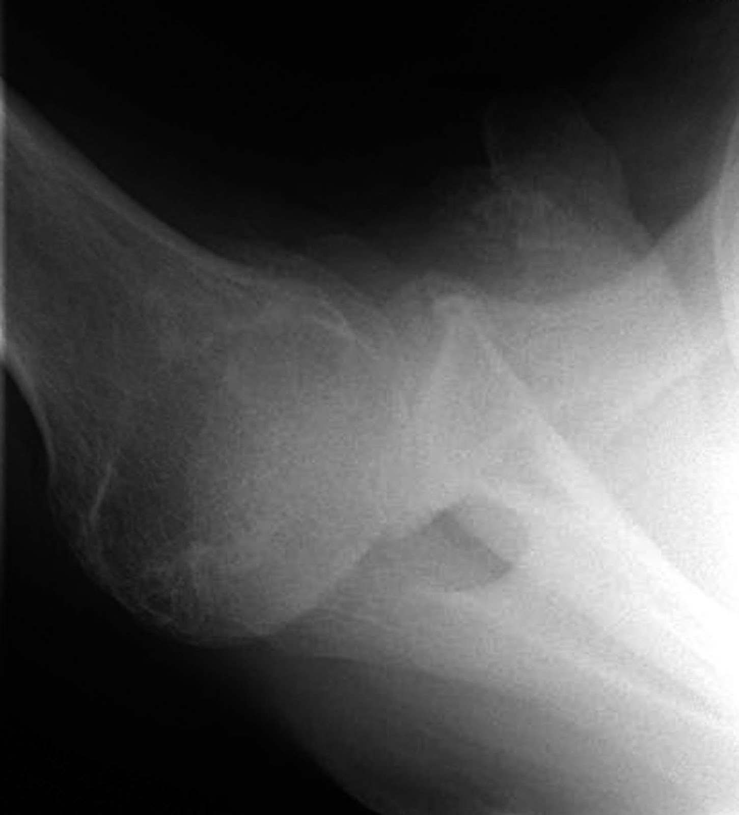 UW Shoulder and Elbow Academy: Shoulder arthroplasty infection with ...