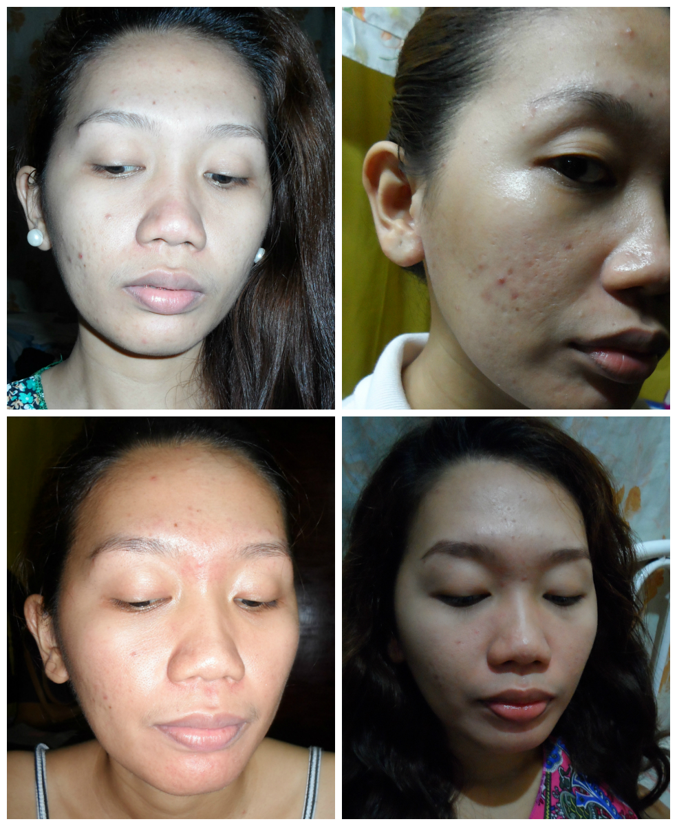 Prettythrifty: Maxi Peel Review : Before and After