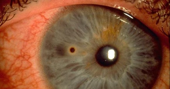 Corneal Infiltrates Images, Symptoms, Causes, Treatment, Healing, Time ...