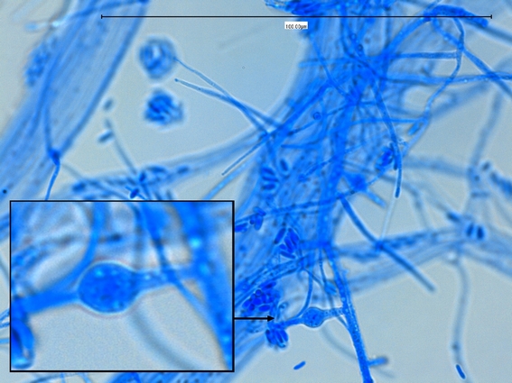 Fun With Microbiology (What's Buggin' You?): Sarocladium kiliense
