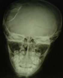 Dr Herry Setya Yudha Utama SpB. FInaCS. MHKes. ICS: Seri Bedah Saraf ...