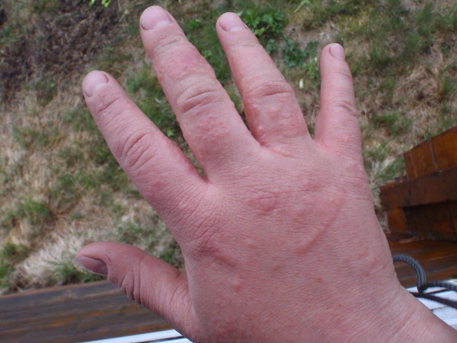 Fieldwork, Travel, and Food: Home early with bad pushki burns