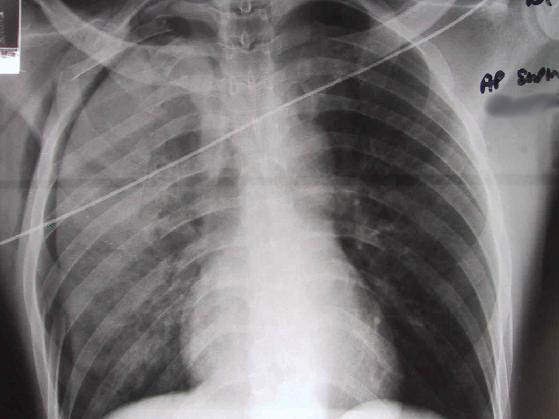 ASUHAN KEPERAWATAN PADA TRAUMA TEMBUS THORAX DENGAN PEMASANGAN BULLOW ...