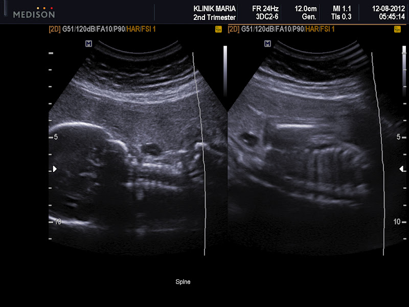 di sini bermula: 3rd pregnancy:detail scan 4D baby adik