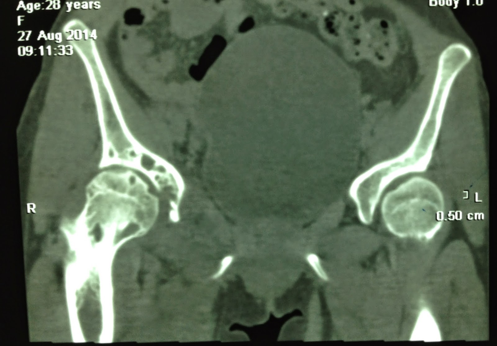 VIETNAMESE MEDIC ULTRASOUND: CASE 283: SCARPA TRIANGLE MASS, Dr PHAN ...