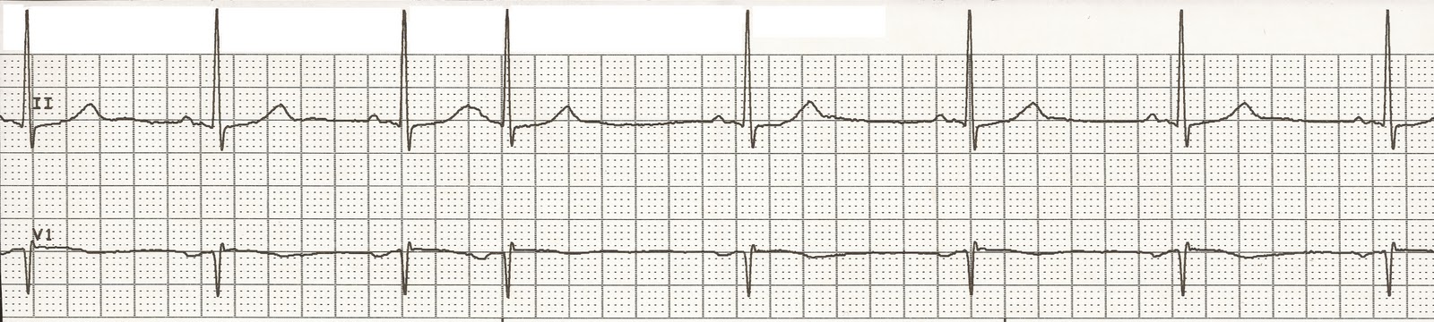 EKG Rhythm Strips 26: Ectopic beats