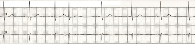 EKG Rhythm Strips 26: Ectopic beats