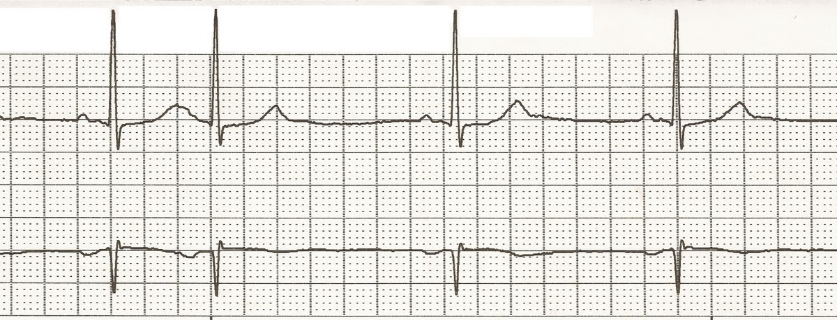 EKG Rhythm Strips 26: Ectopic beats