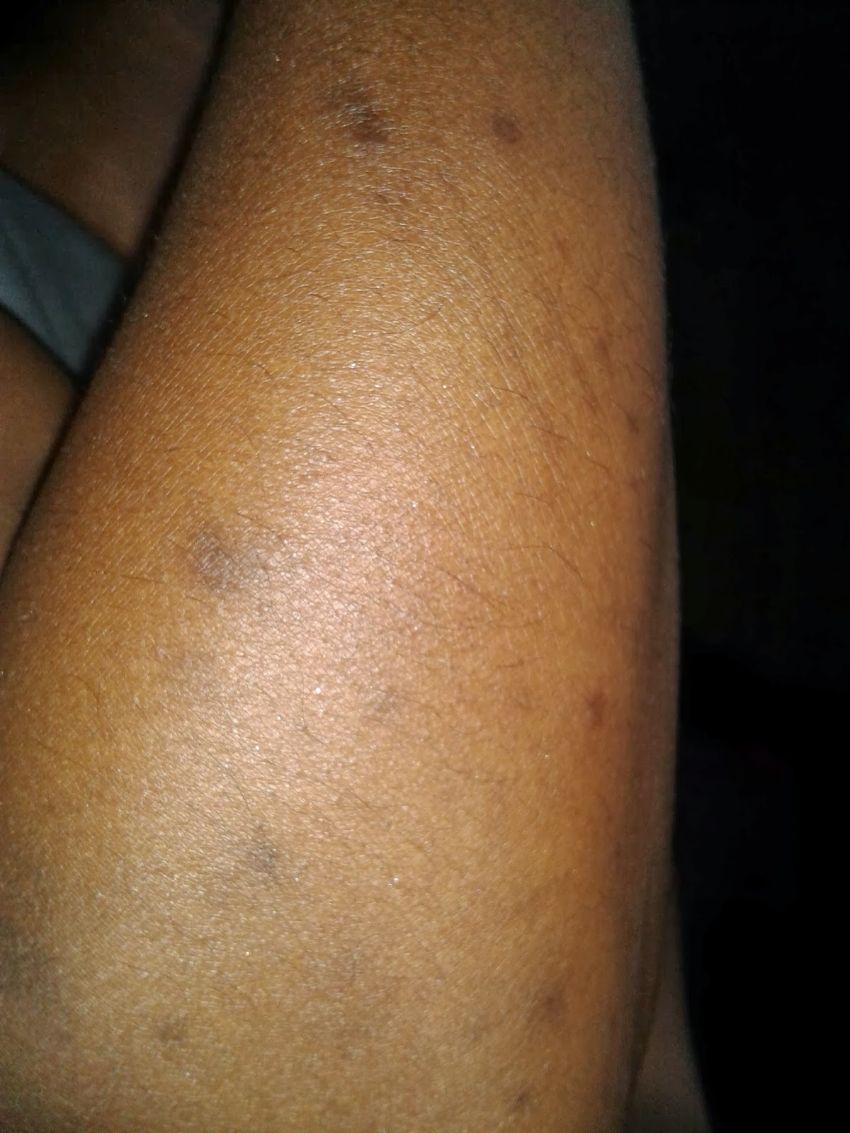 MY Froclite: Les taches noires de ma vie