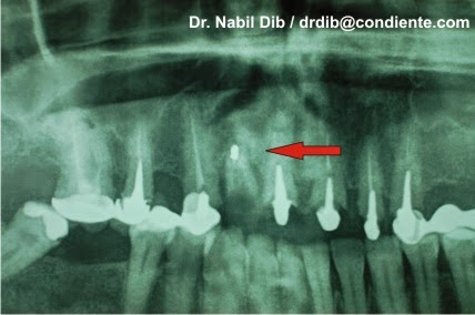 Dr. Nabil Dib: Extraccion de Resto Radicular UD 12 / Tooth extraction ...