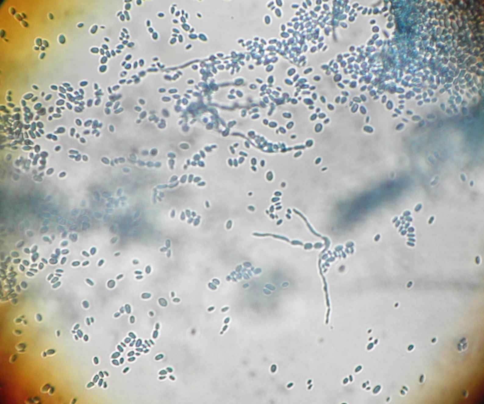 ATLAS MICOLOGIA: EXOPHIALA DERMATITIDIS