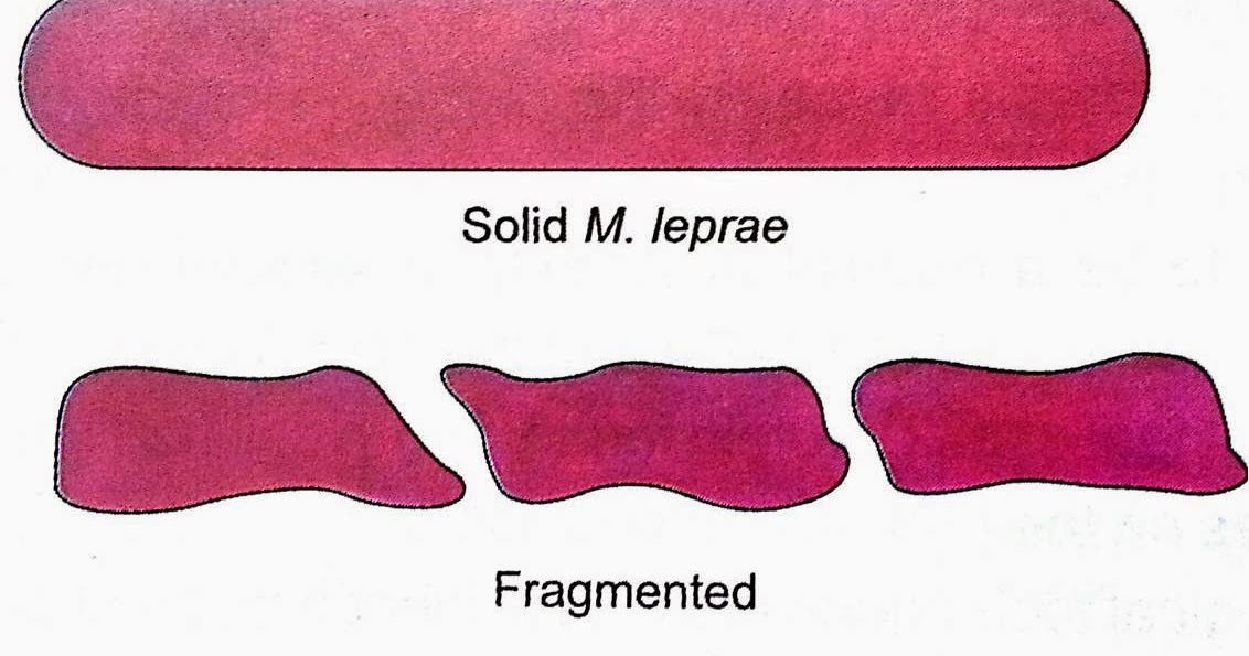 Teledermatology for PG entrance: Slit skin smear in Leprosy