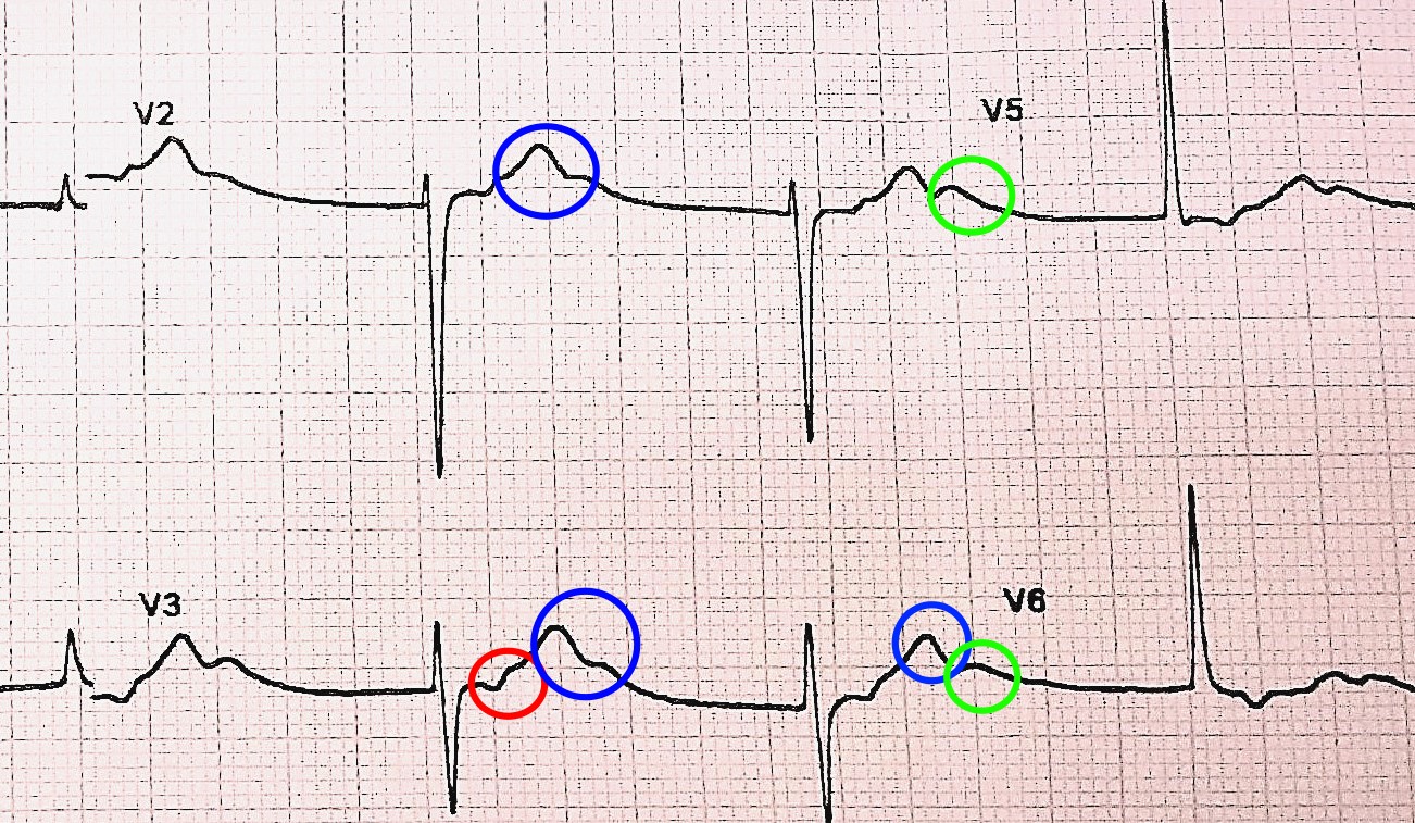 ECG Challenge 3 - Inverted waves