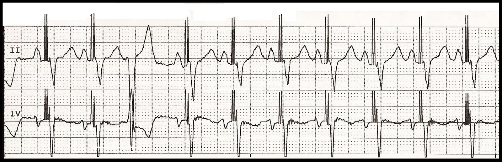 EKG Rhythm Strip Quiz 100: Paced rhythms