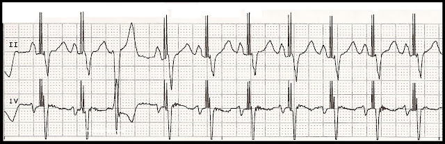 EKG Rhythm Strip Quiz 100: Paced rhythms