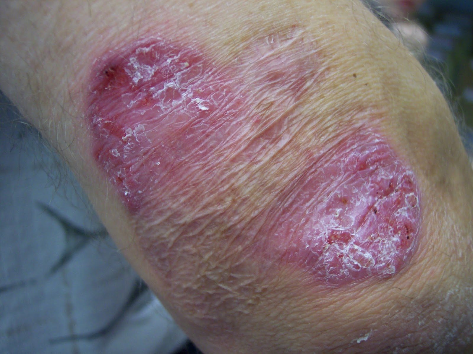 Your Skin for Life: Psoriasis Awareness Month