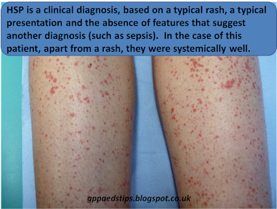 Paediatrics for Primary Care (and anyone else): Henoch Shonlein Purpura ...