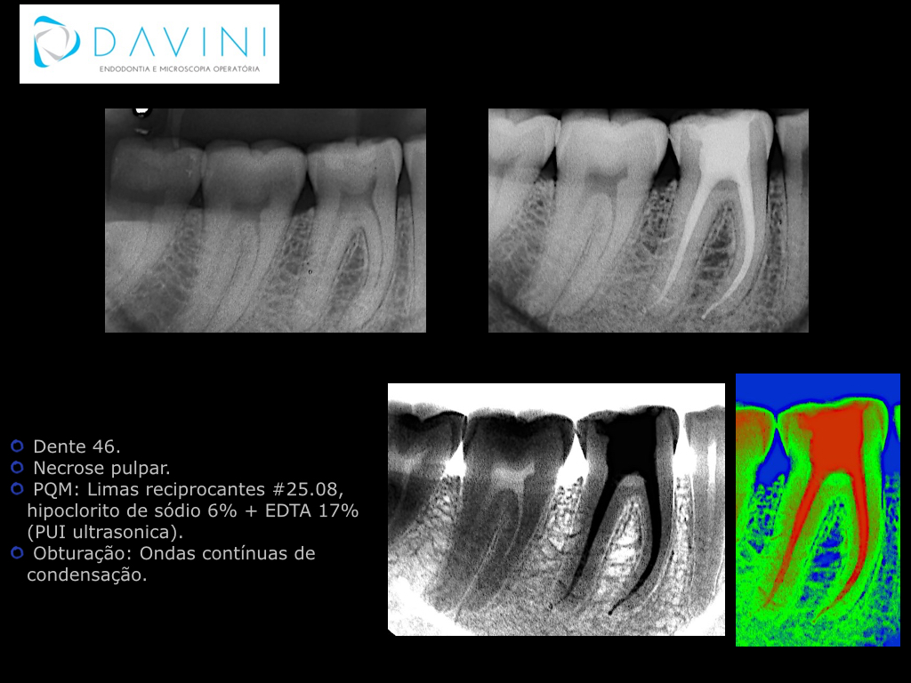 Davini - Endodontia e Microscopia Operatória: Tratamento endodôntico ...