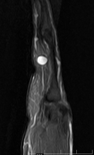 Ganglion Cyst Mri Sumers Radiology Blog