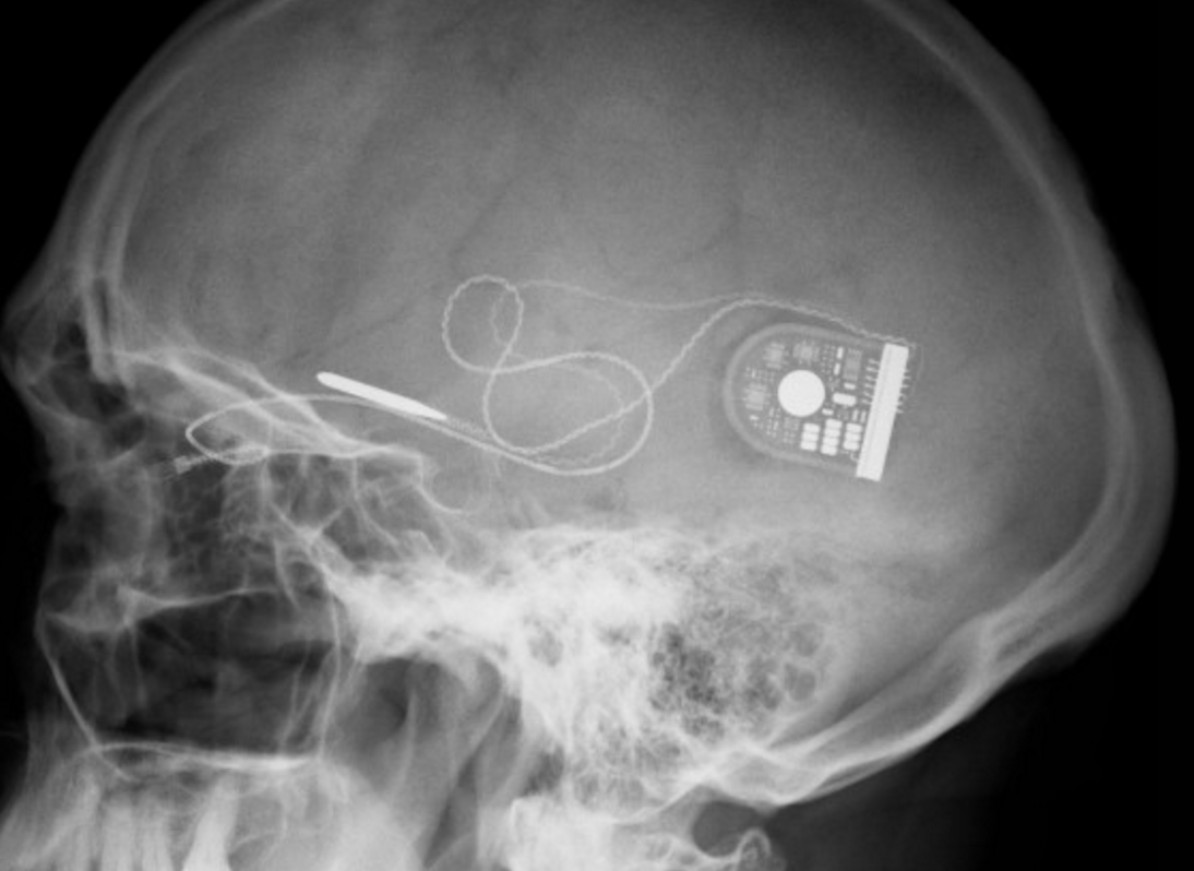 DARPA improving memory with brain implants | NextBigFuture.com