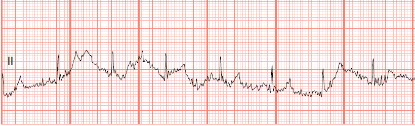 Basic EKG Rhythm Test 44