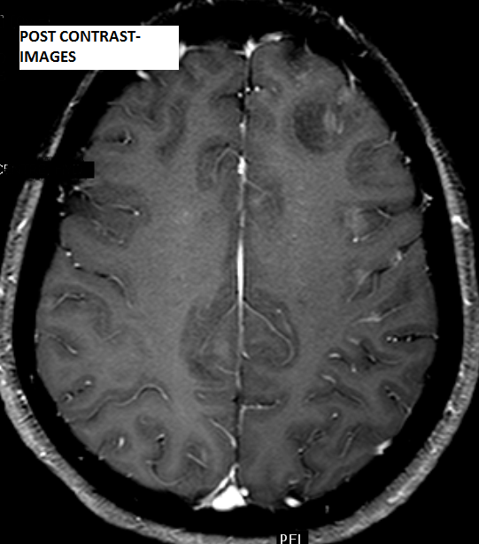 HIV Encephalopathy-MRI - Sumer's Radiology Blog