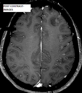 HIV Encephalopathy-MRI - Sumer's Radiology Blog