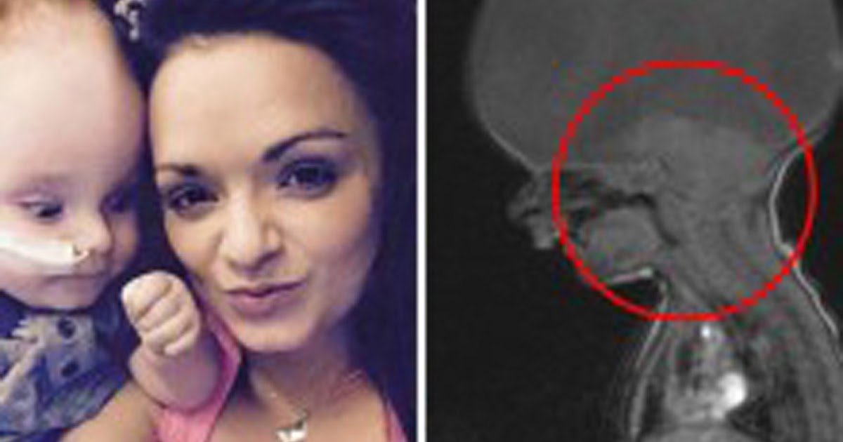 HE WAS BORN WITHOUT BRAIN BUT HE DID SOMETHING AMAZING ON HIS SECOND ...