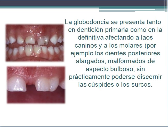 DENTAL 1001 UNAM: Macro y Microdoncia, y otras Anomalías Dentales ...