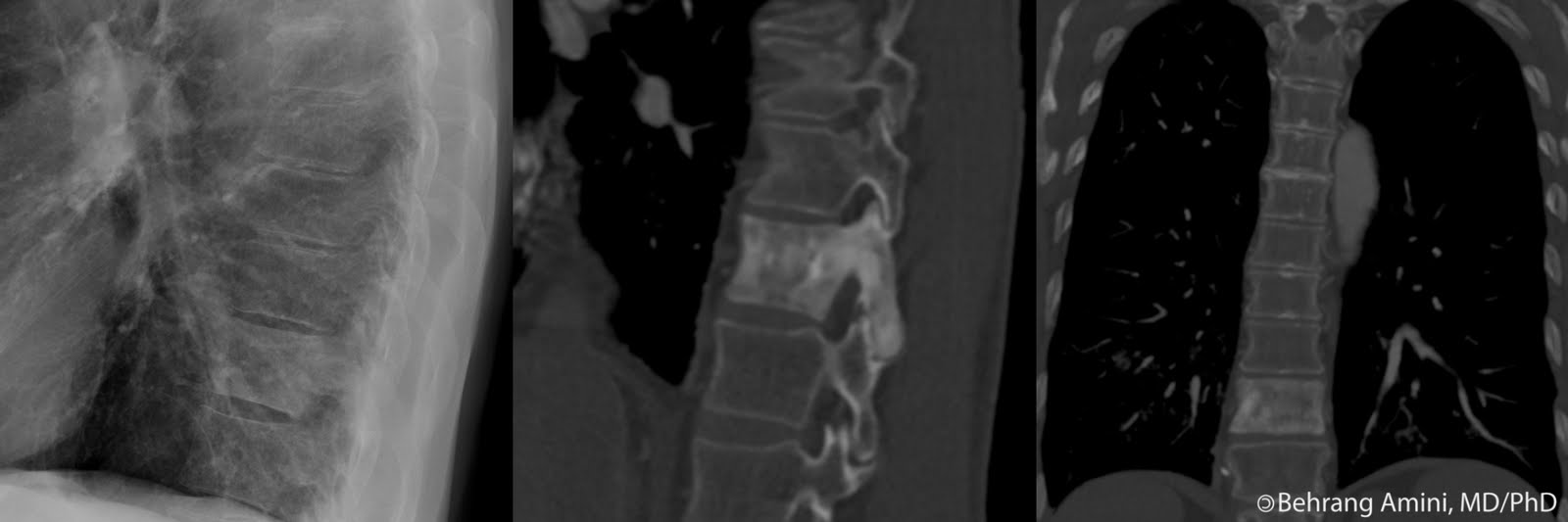 Roentgen Ray Reader: Ivory Vertebra