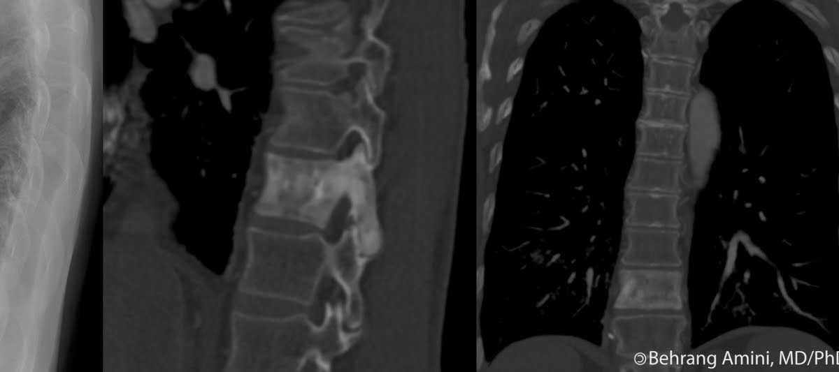 Roentgen Ray Reader: Ivory Vertebra