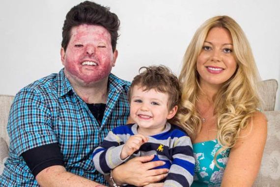 Photos: Ten months later, acid attack victim speaks. "I could feel my ...