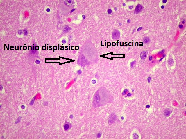 LAICI - Laboratório de Investigação de Câncer e Inflamação: Deposições ...