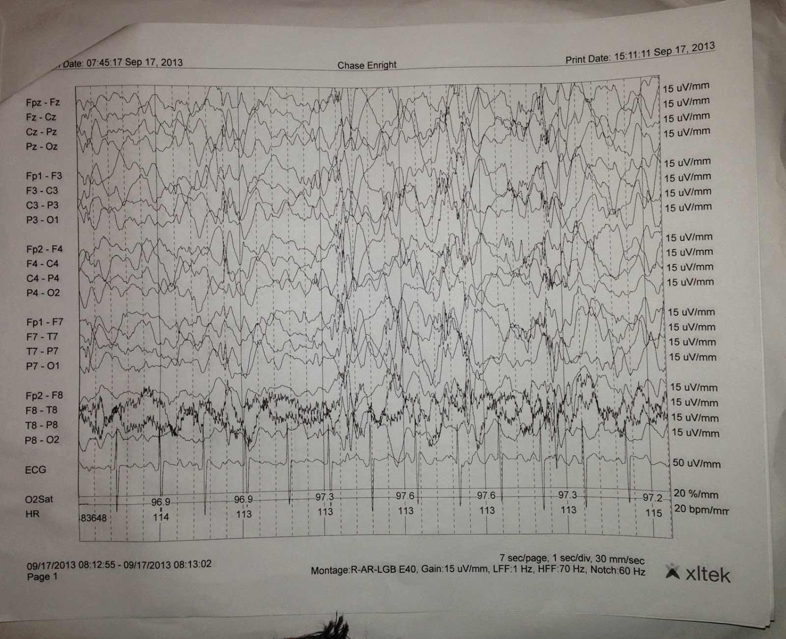 Chase's Journey with Infantile Spasms : Hospitalization- Beginning the ...