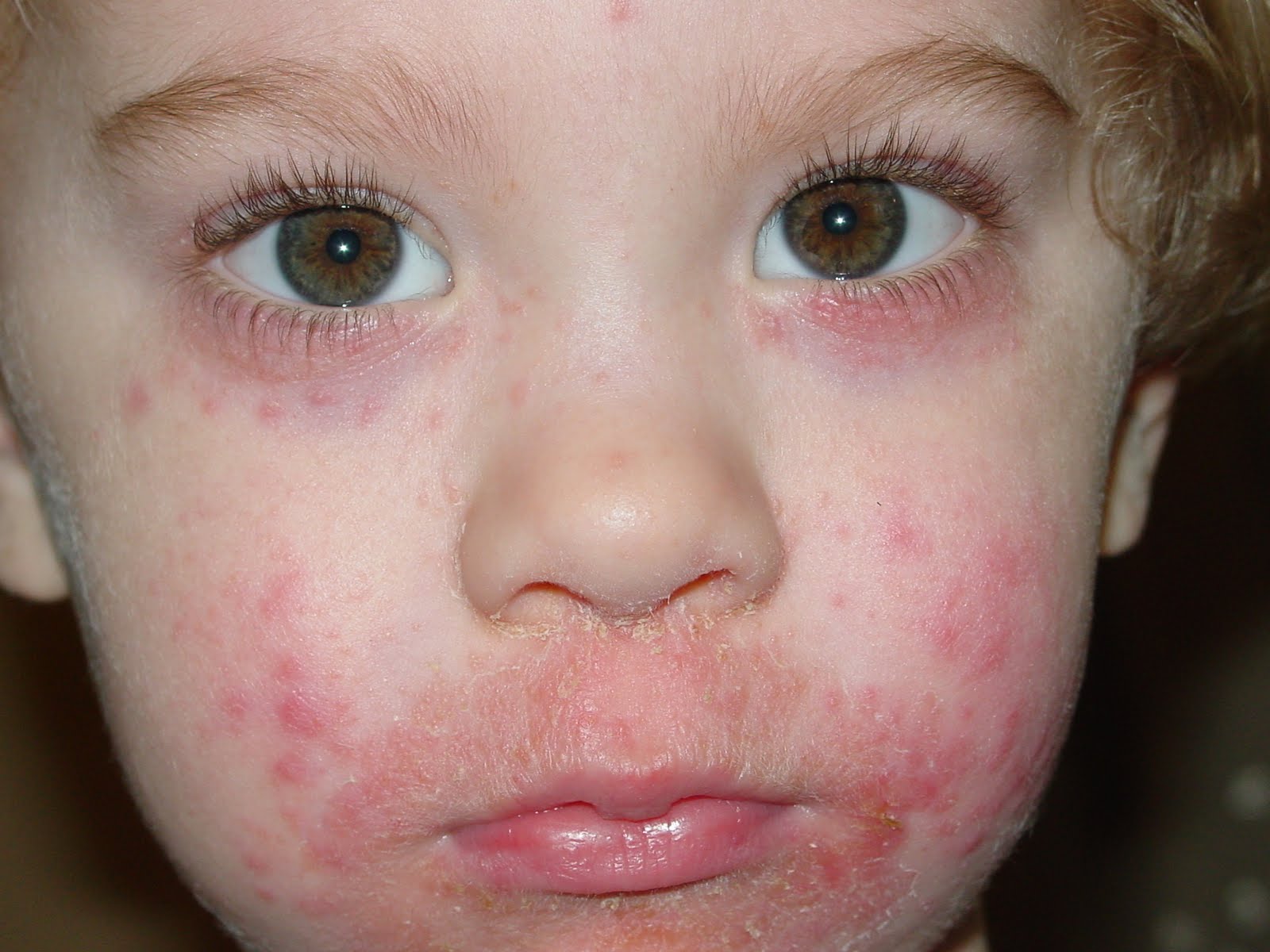 perioral dermatitis - DrBeckmann