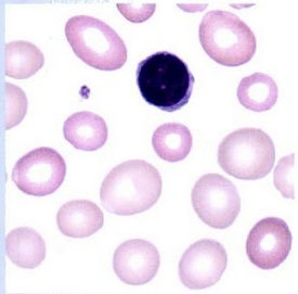 FICHERO HEMATOLOGIA : Macrocitos ovales