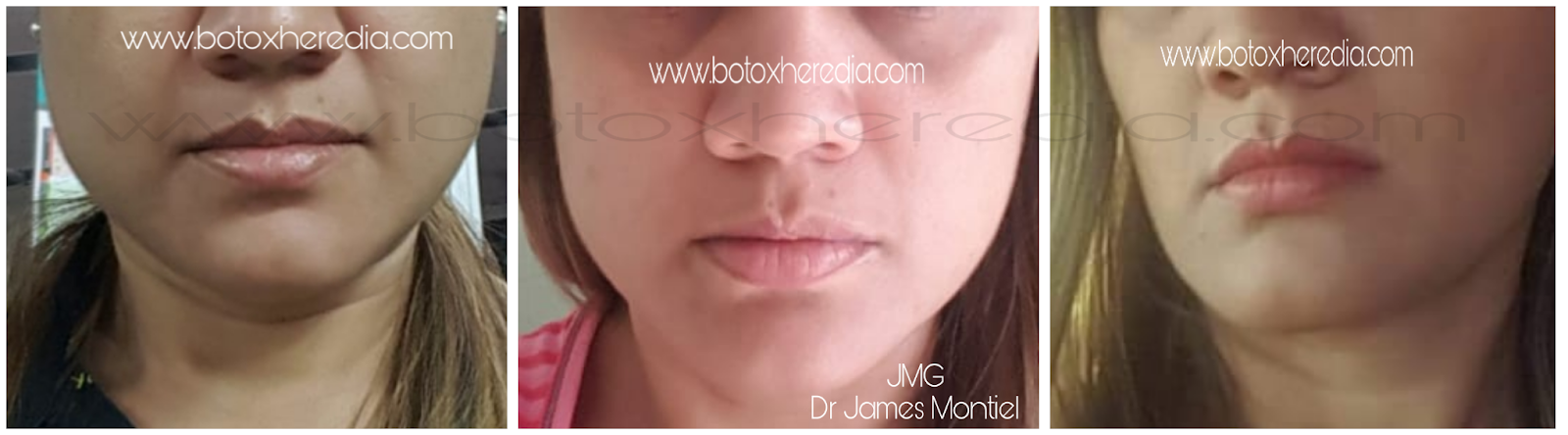 Botox, Acido Hialurónico, Bichectomia, Invisible Touch Hilos Pdo