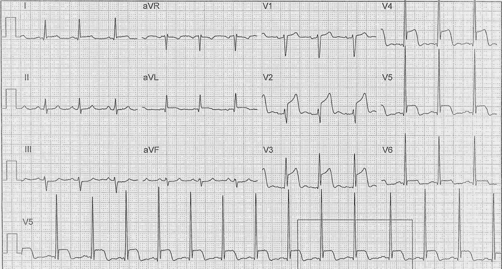 ECG of the Week: ECG of the Week - 29th December 2014 - Interpretation