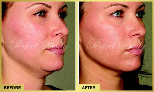 Perfect Body Laser and Aesthetics: Ultherapy Long Island