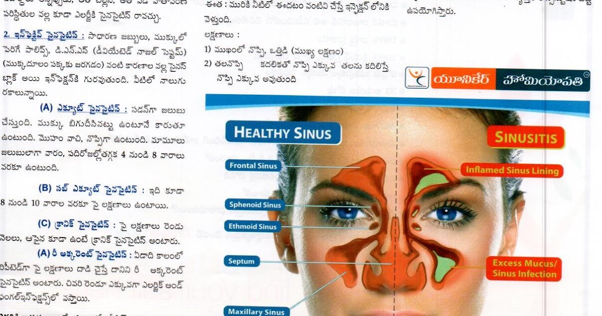 TELUGU WEB WORLD: Sinus Infection (Sinusitis) Symptoms, Treatment ...