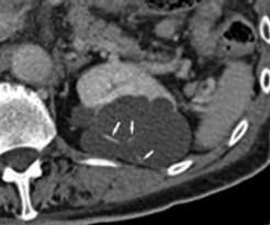X-RAYview: QUISTOS RENAIS - Classificação de Bosniak