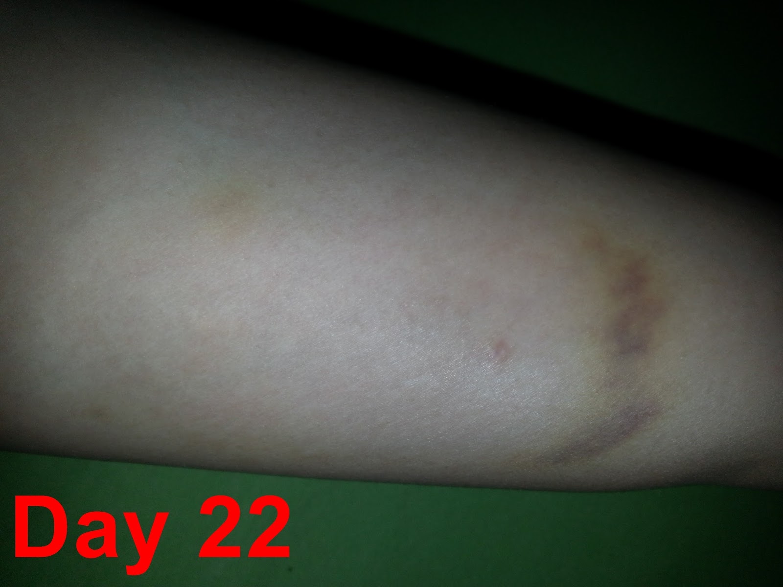 My experience with the birth control Implanon