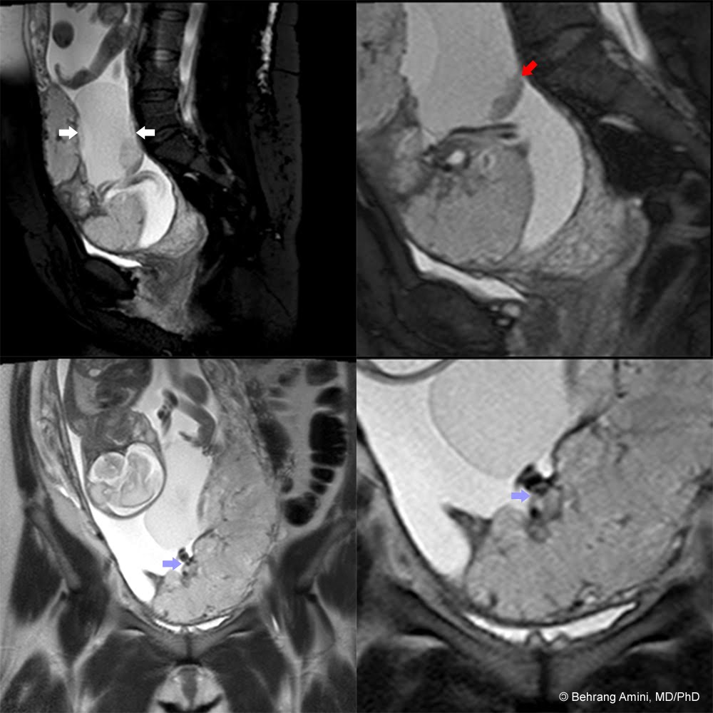 Roentgen Ray Reader: Placental Surface Cyst