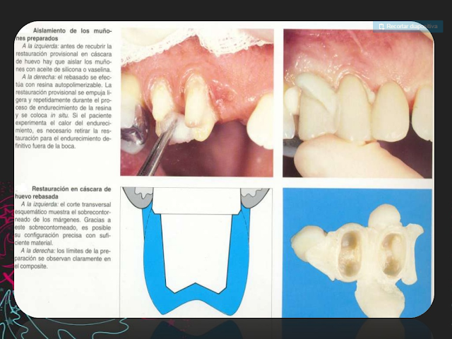 Provisionales dentales