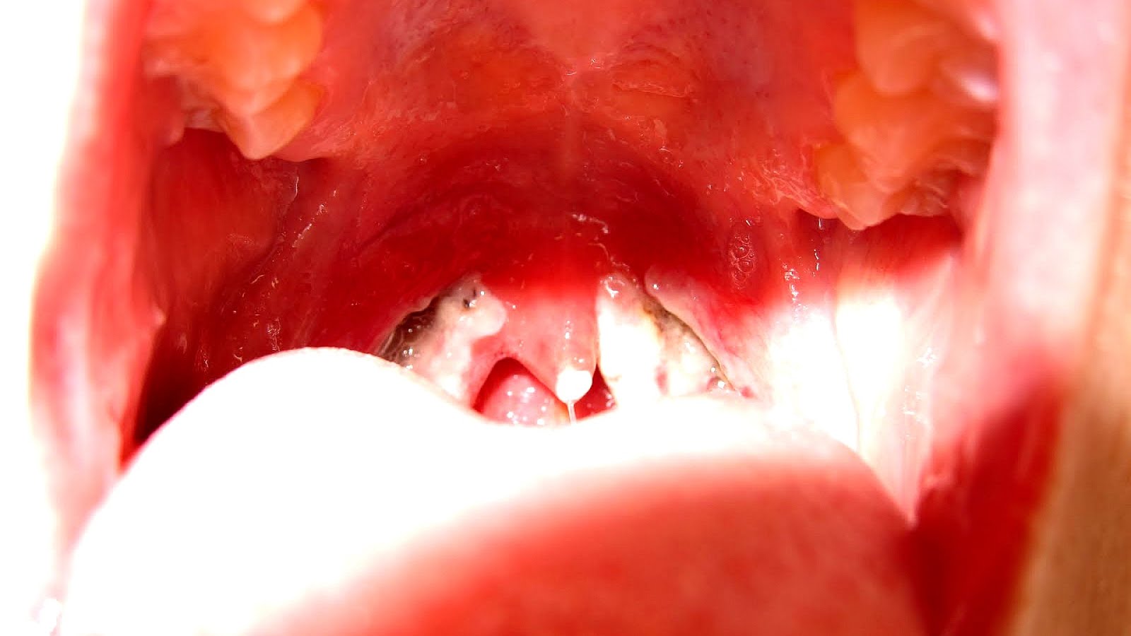 Ulcer On Uvula Ulcer Choices