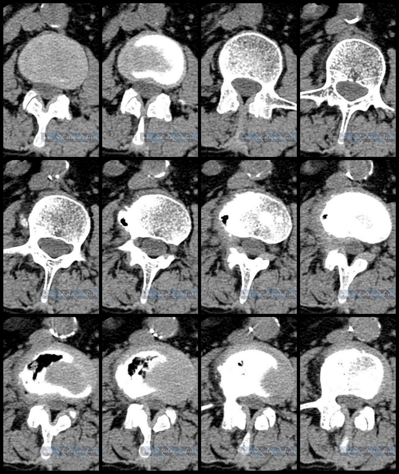 Radiology Archives: Φαινόμενο Κενού Μεσοσπονδυλίου Δίσκου