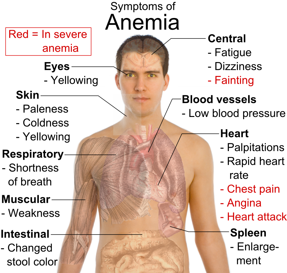 ANEMIA : BAHAYA ATAU TIDAK?